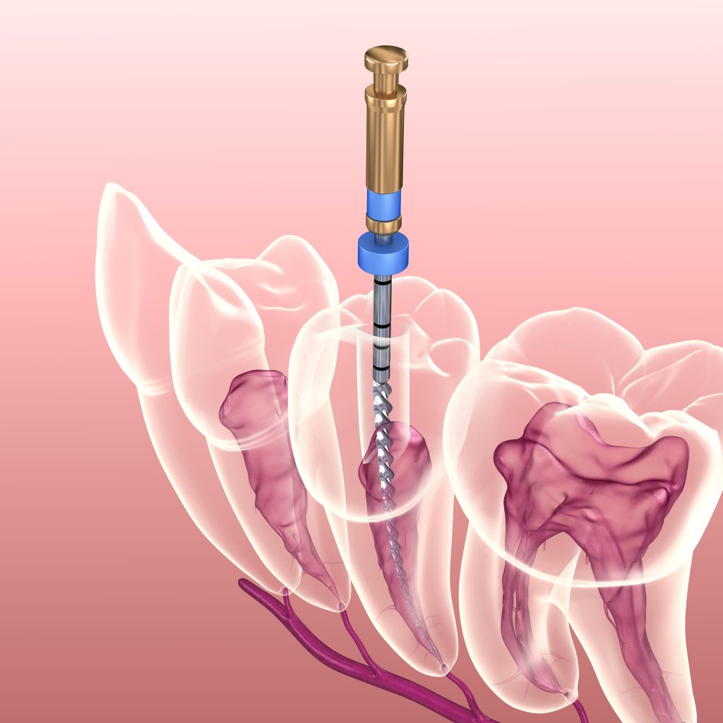 Post-Root Canal Pain: 4 Warning Signs You Shouldn’t Ignore