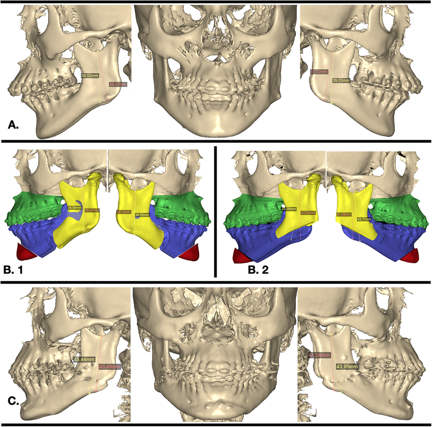 7 Facts About Chin Wing Osteotomy for Jawline Redefinition