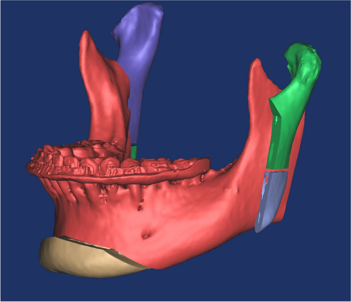Chin Reduction Surgery: 5 Key Facts for Facial Balance