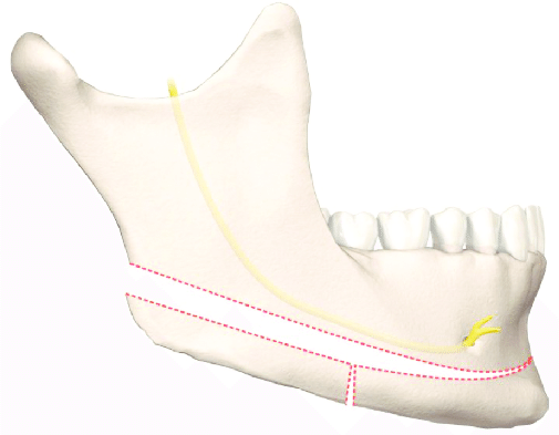 7 Facts About Chin Wing Osteotomy for Jawline Redefinition