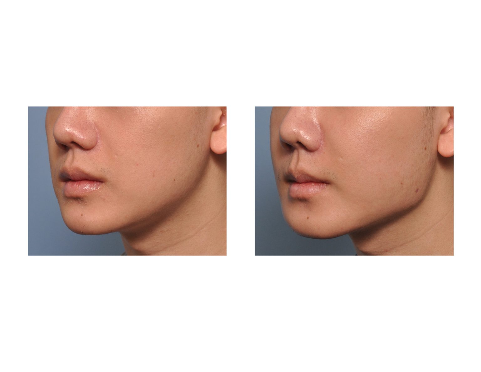 7 Facts About Chin Wing Osteotomy for Jawline Redefinition