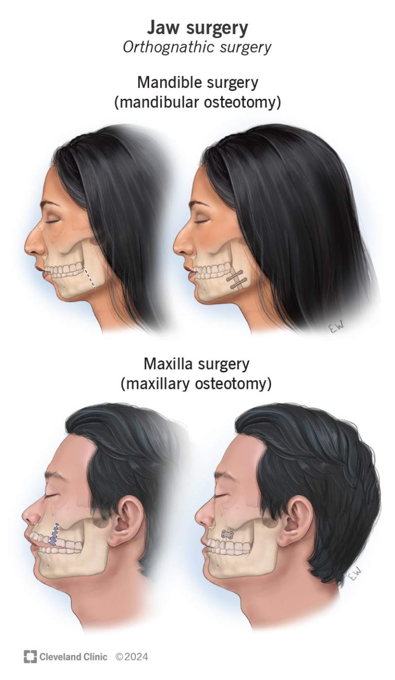 7 Facts About Chin Wing Osteotomy for Jawline Redefinition