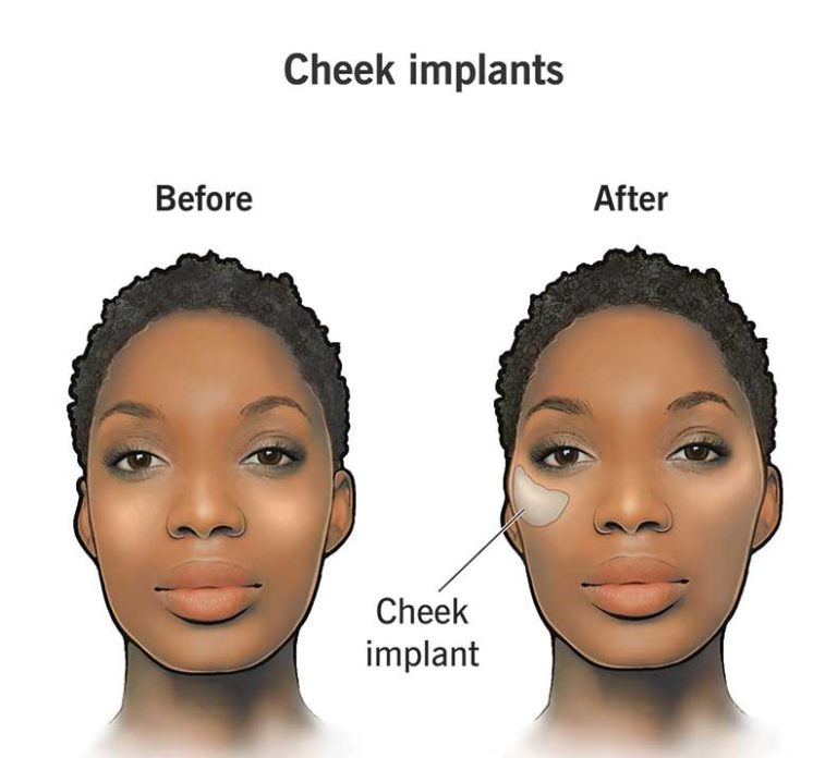 3 Cheek Implants Dubai Benefits for a More Defined Midface